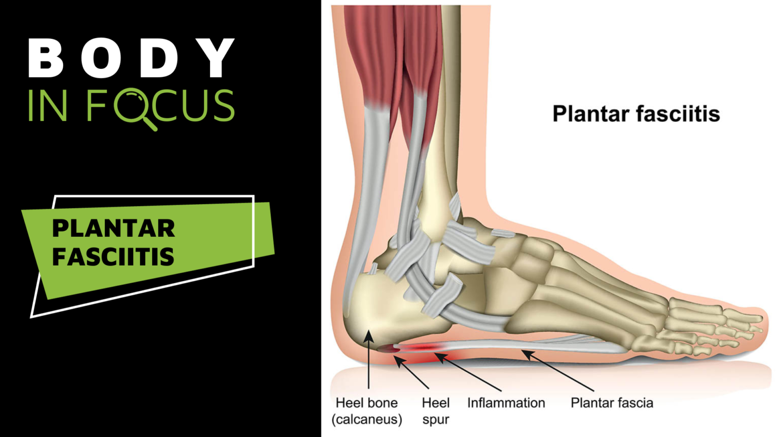 Stepping Pain-Free: How to Relieve Plantar Fasciitis - pilates